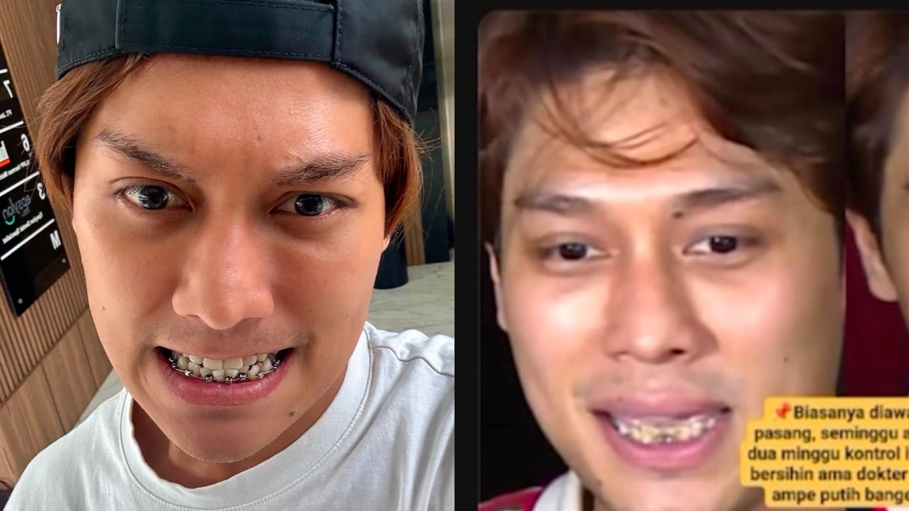 Dikecam Gigi Kuning, Rizky Billar Terus Pergi Cuci - “Dah ‘Scalling ...